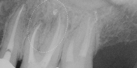 Behandlungsbeispiel :: Therapie chronisch entzündeter Backenzahn